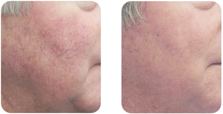 Excel V Rosacea & Vascular Laser Treatment - 仁恩醫學