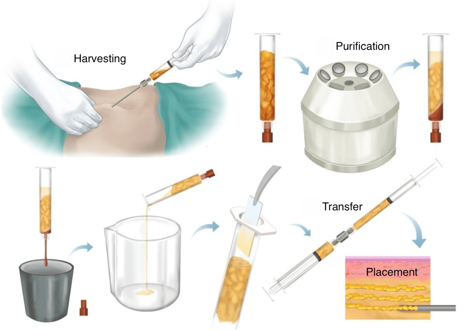 Fat Transfer - 仁恩醫學