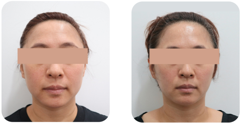 Tentherma Monopolar RF - 仁恩醫學