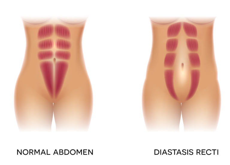 Postpartum Diastasis Recti - 仁恩醫學