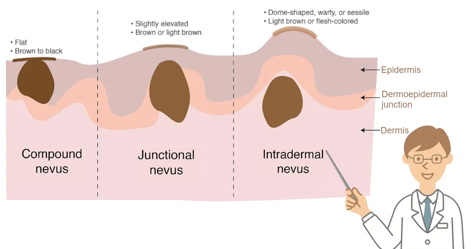 癦痣Pigmented Mole - 仁恩醫學