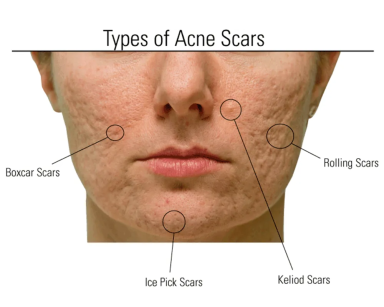 Scar Subcision - 仁恩醫學