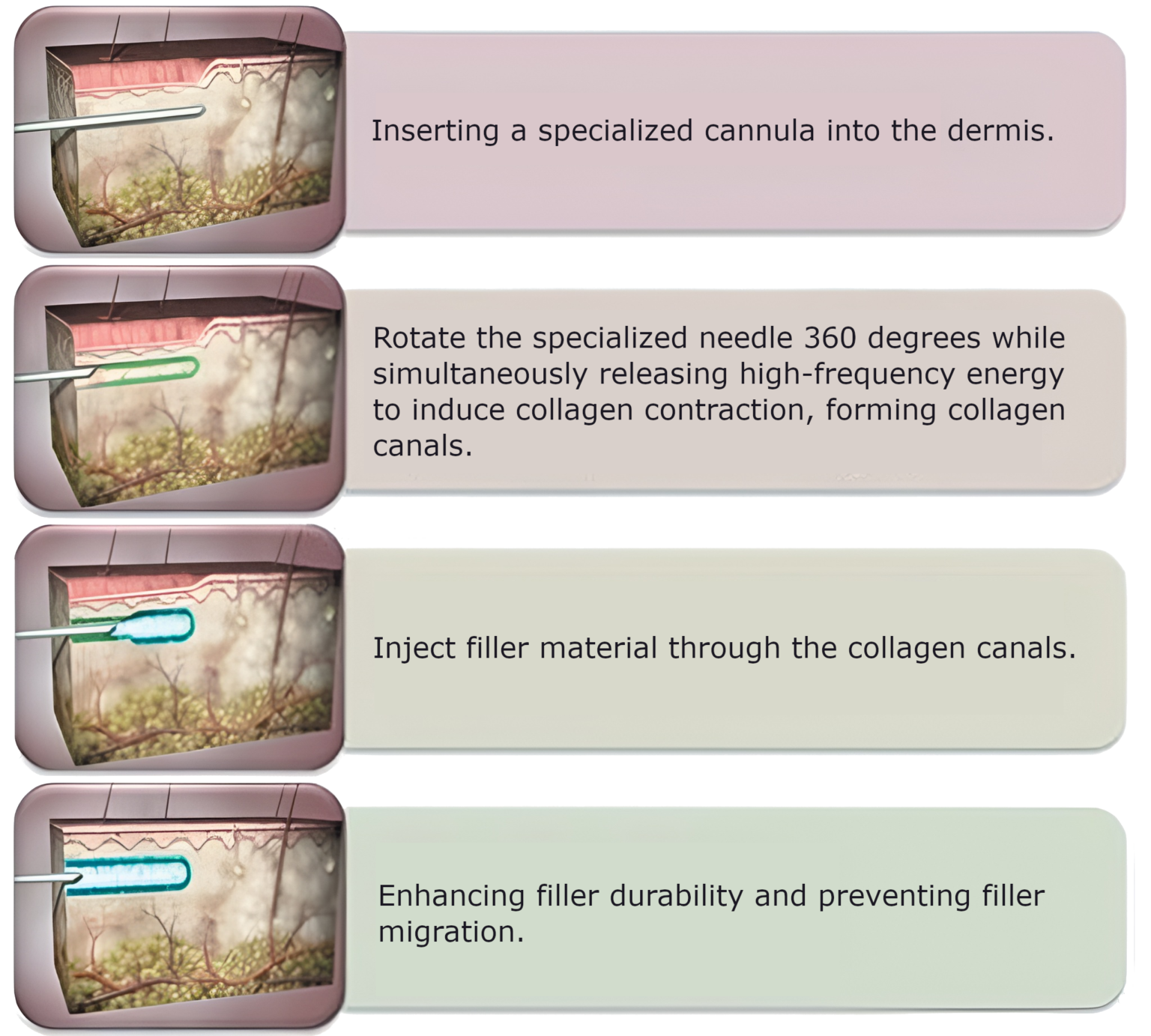 Scar Subcision - 仁恩醫學